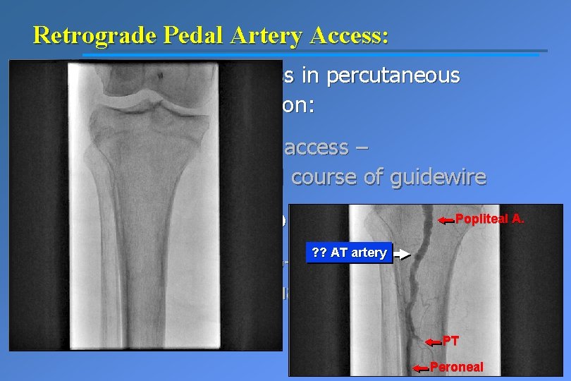 A Primer to Percutaneous Endovascular intervention Retrograde Distal
