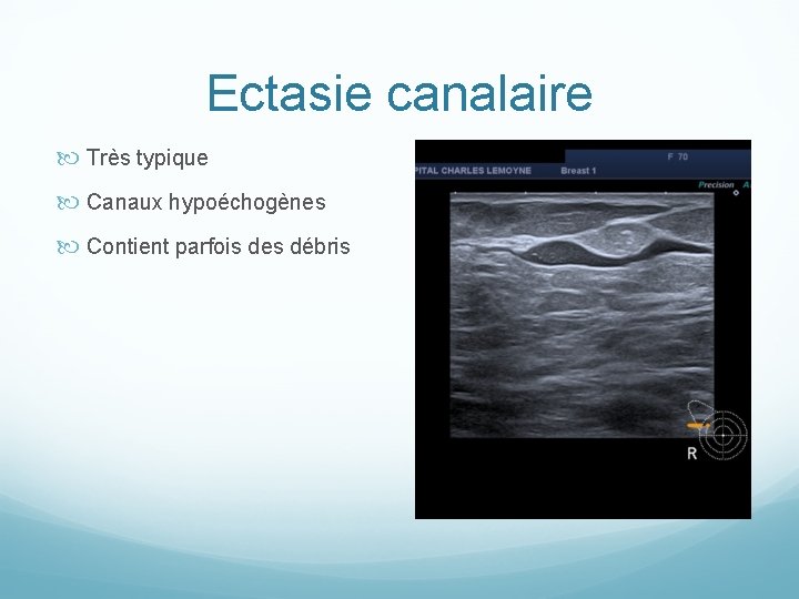 Les Lsions Bnignes du Sein Comment sy retrouver