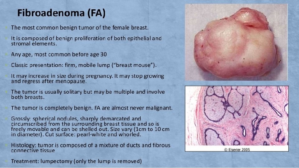 BREAST 34 Fibrocystic Diseasechange Pathology Harmone induced acinar