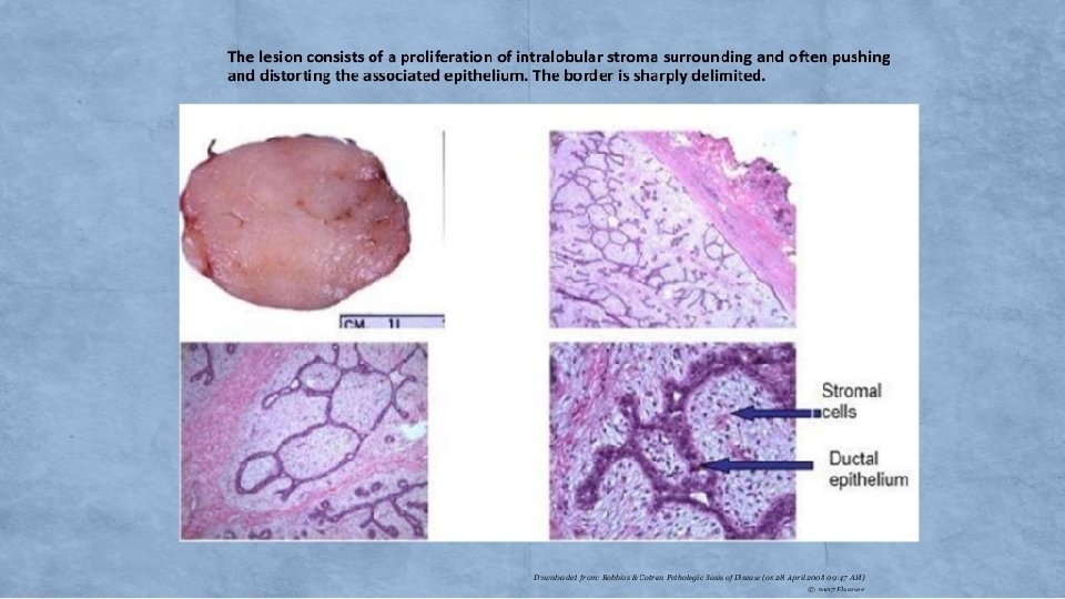 BREAST 34 Fibrocystic Diseasechange Pathology Harmone induced acinar