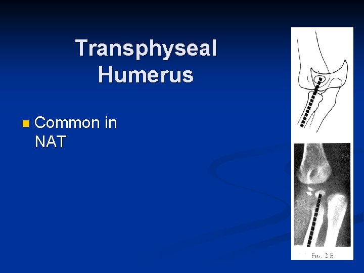 Orthopaedic Aspects of Child Abuse NAT Abdulaziz Alomar