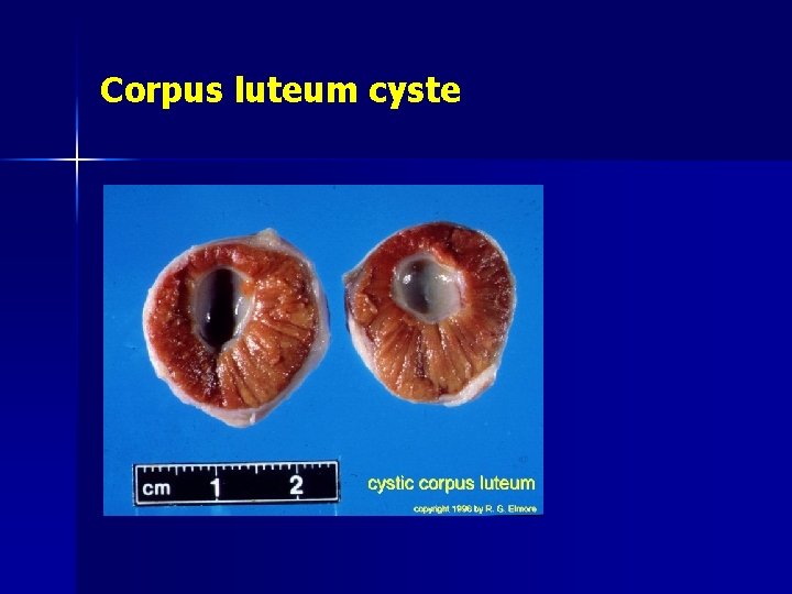 Benigne ovarile pathologie J Bosteels AZ Imelda Bonheiden