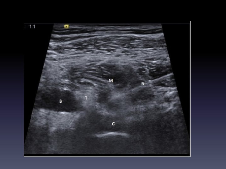 PSOAS TENDONITIS IN DAA ANTHONY S UNGER MD