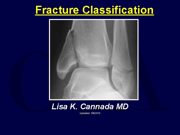 Fracture Classification Lisa K Cannada MD Updated 052016