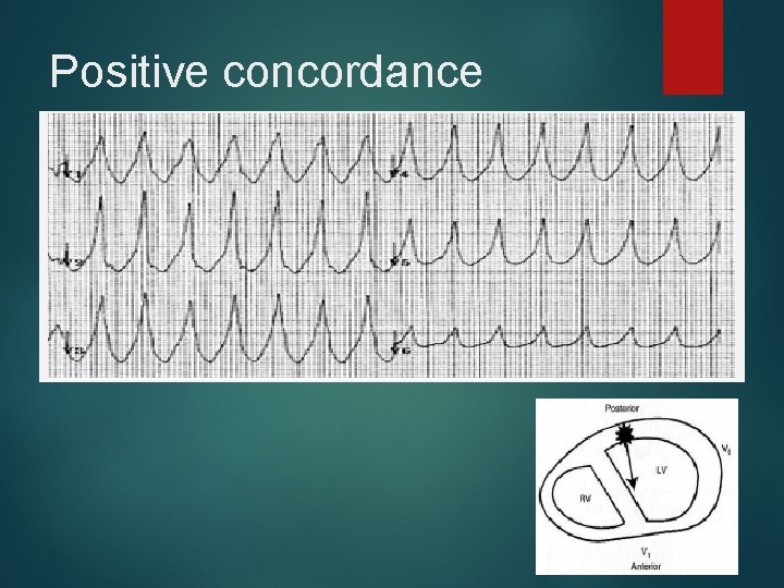WIDE COMPLEX TACHYCARDIA Definitions Wide QRS complex tachycardia