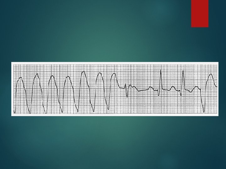 WIDE COMPLEX TACHYCARDIA Definitions Wide QRS complex tachycardia