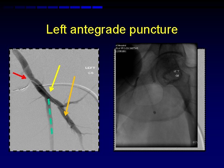 Antegrade Femoral and Retrograde Popliteal Artery Access Aravinda