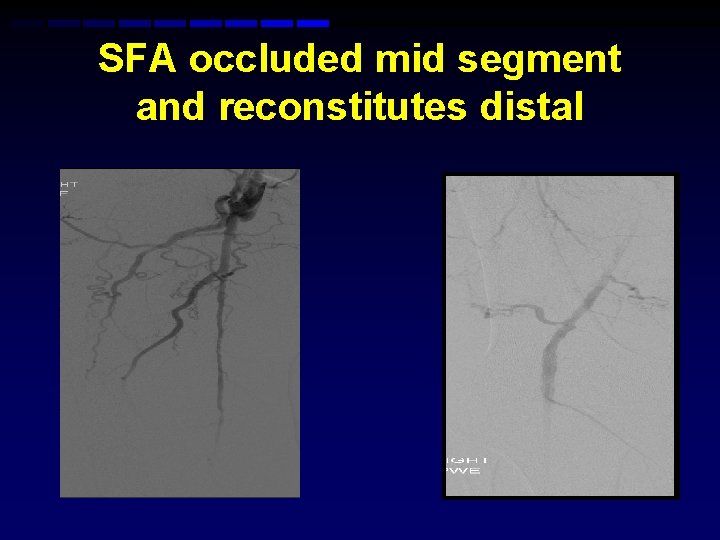 Antegrade Femoral and Retrograde Popliteal Artery Access Aravinda