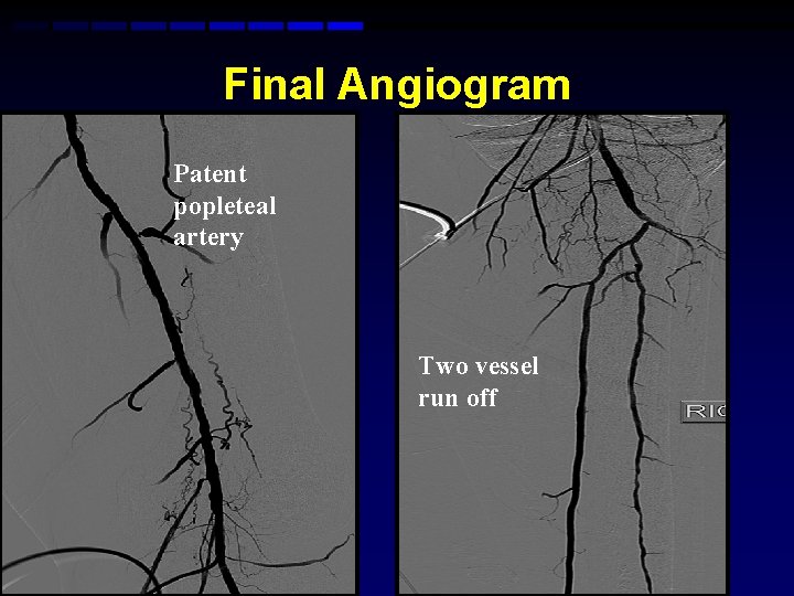Antegrade Femoral and Retrograde Popliteal Artery Access Aravinda