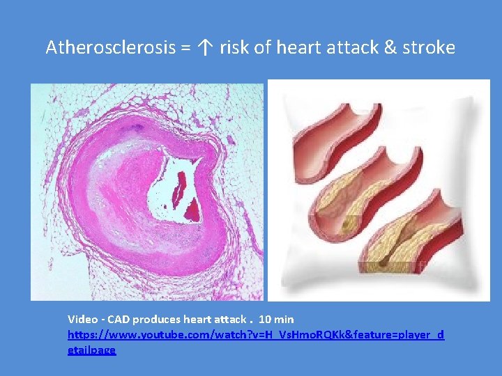 CVD CAD PAD and HTN CVD CAD Plaque