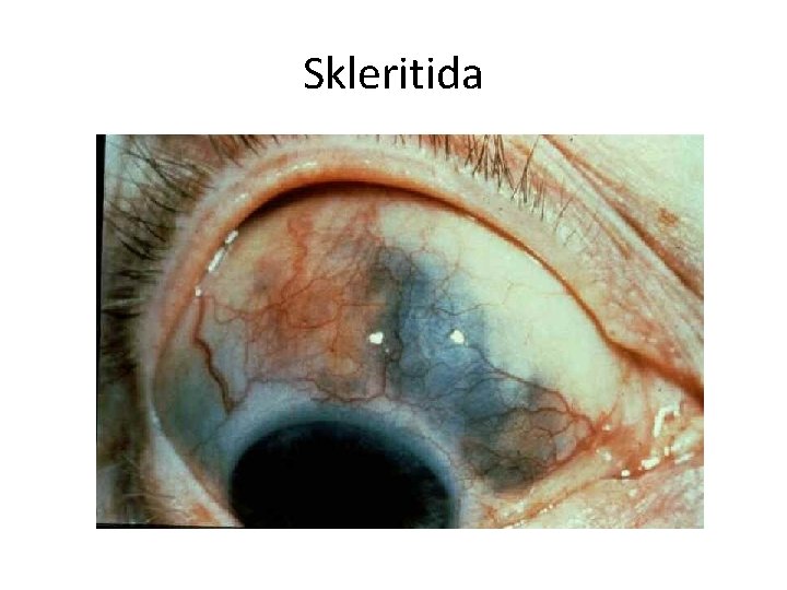 Oko a systmov choroby Spojivka Neinfekn znty spojivky