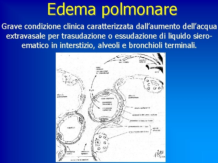 Edema polmonare Grave condizione clinica caratterizzata dallaumento ...