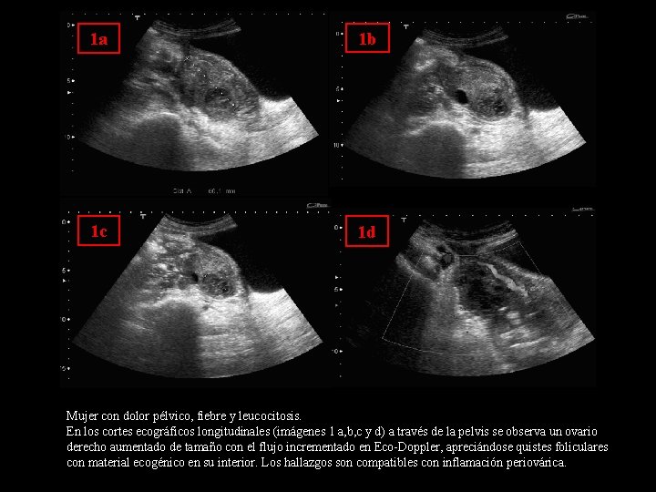 ENFERMEDAD PLVICA INFLAMATORIA EPI como causa de dolor