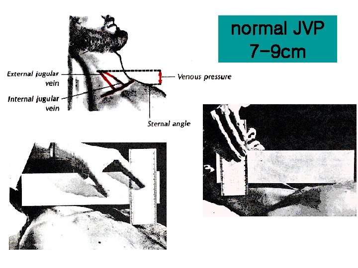 CASE 1 PEx BP13476 mm Hg HR133min JVD