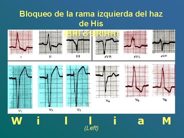 Anlisis e interpretacin del ECG convencional Artefactos P