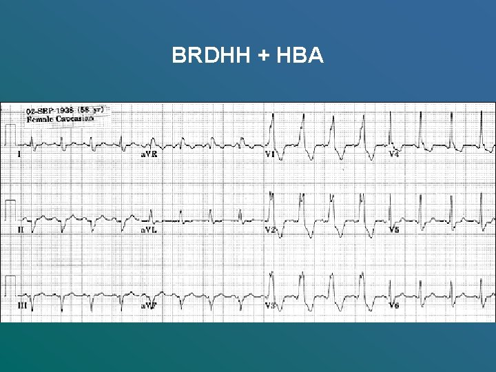 Anlisis e interpretacin del ECG convencional Artefactos P