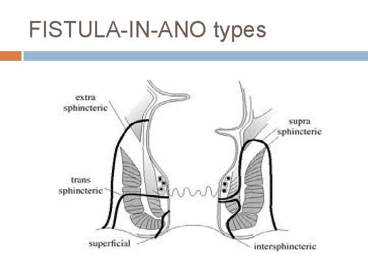 PERIANAL SUPPURATION ANAL ABSCESSFISTULA Anatomy anal glands anal