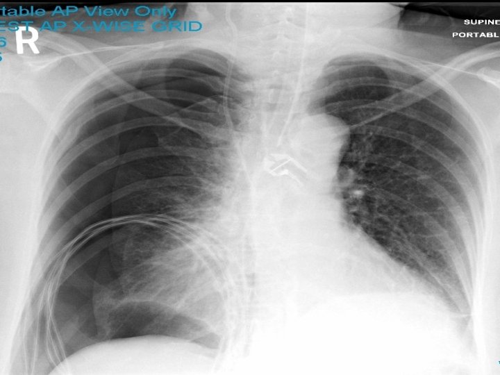 Ultrasound Guided Central Venous Cannulation CVC Shirley Lee