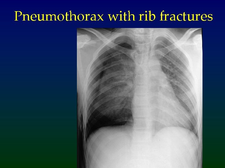 Pneumothorax What is a pneumothorax Air within the