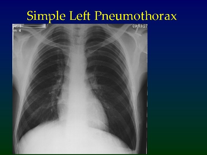 Pneumothorax What is a pneumothorax Air within the