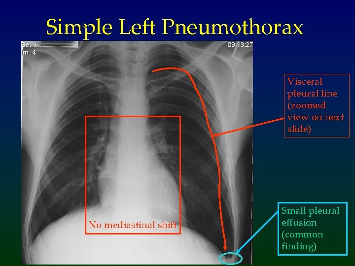 Pneumothorax What is a pneumothorax Air within the