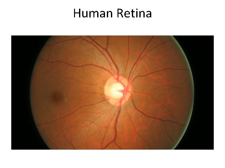 Large Analysis of microvascular lesions in the brain