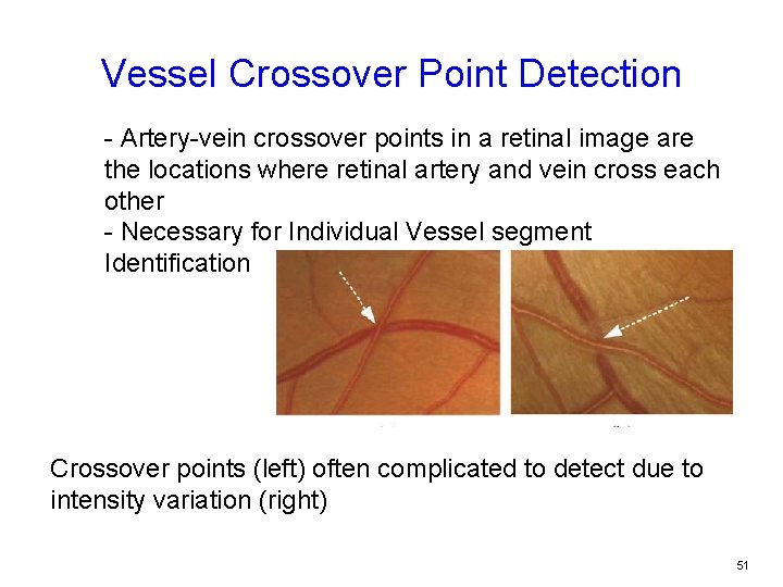 Large Analysis of microvascular lesions in the brain