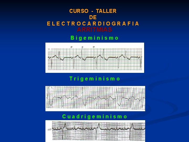 CURSO TALLER DE ELECTROCARDIOGRAFIA A R R I