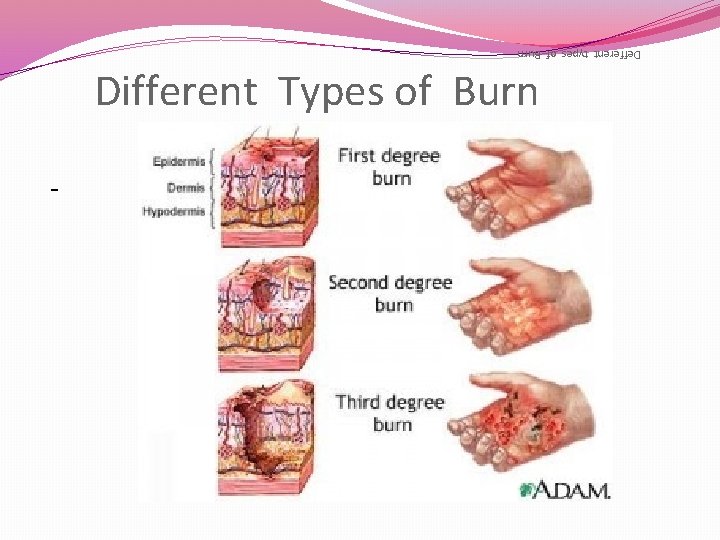 Case study on acute burn injury from an