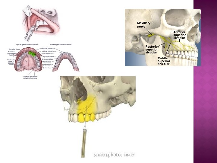 The anterior superior alveolar ASA nerve block is