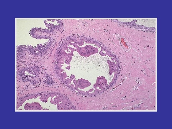 LESIONI BENIGNE DELLA MAMMELLA Mammella latino mamma trasmissione