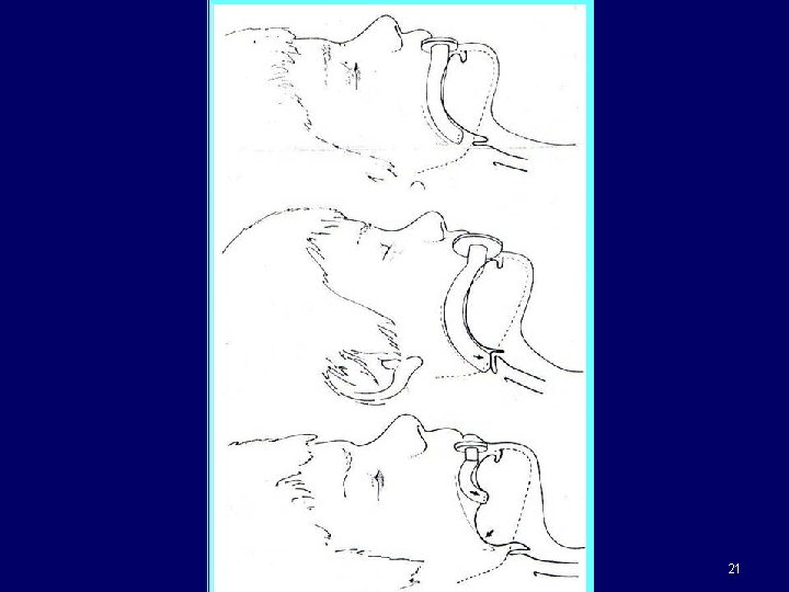 EVALUACION Va area permeable la respiracin es adecuada