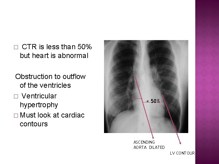 CARDIAC XRAY PRESENTED BY DR SANDEEP R 1