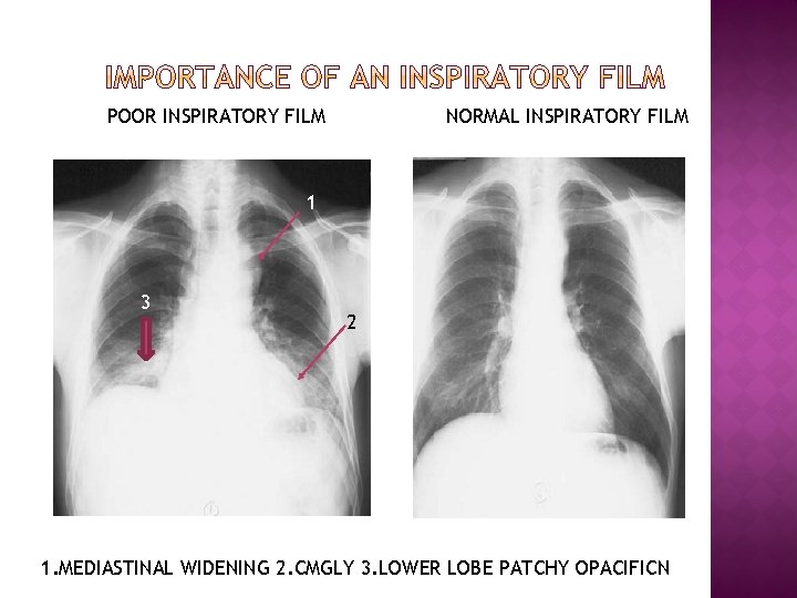 CARDIAC XRAY PRESENTED BY DR SANDEEP R 1