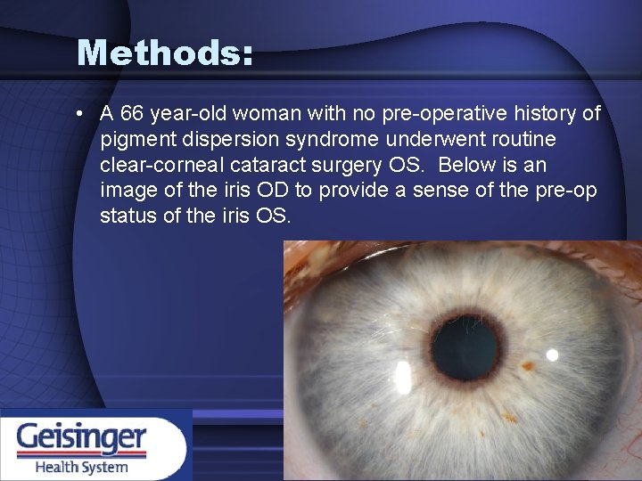 Severe Iris Pigment Epithelium Desquamation After Routine Cataract