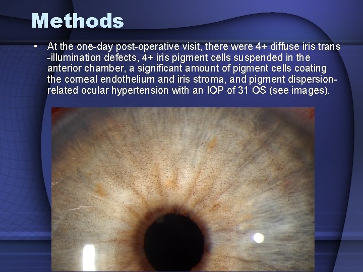 Severe Iris Pigment Epithelium Desquamation After Routine Cataract