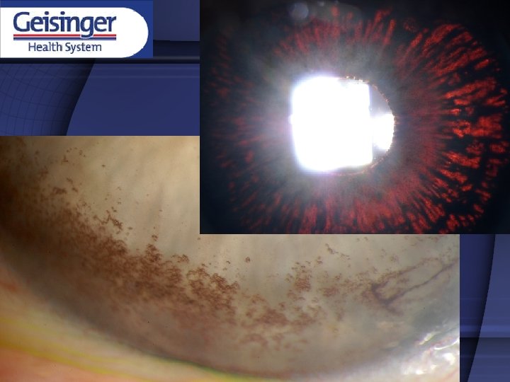 Severe Iris Pigment Epithelium Desquamation After Routine Cataract