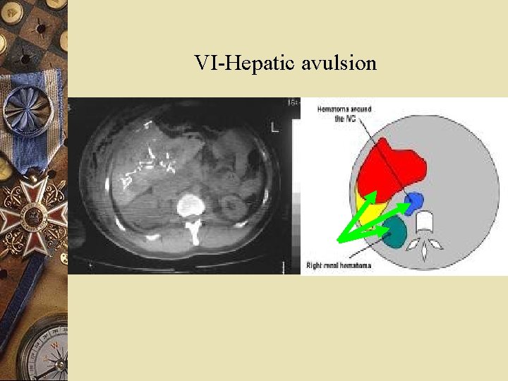 Liver Trauma Mohamed Hashim Milhim 4 th year
