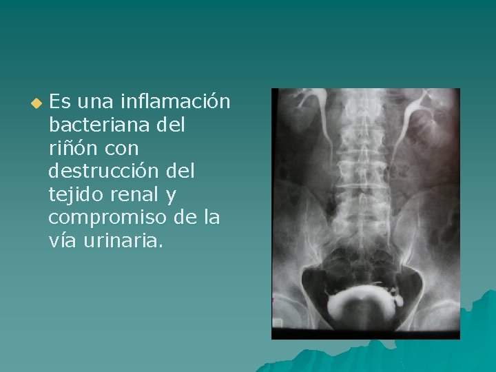 PIELONEFRITIS u Es una inflamacin bacteriana del rin
