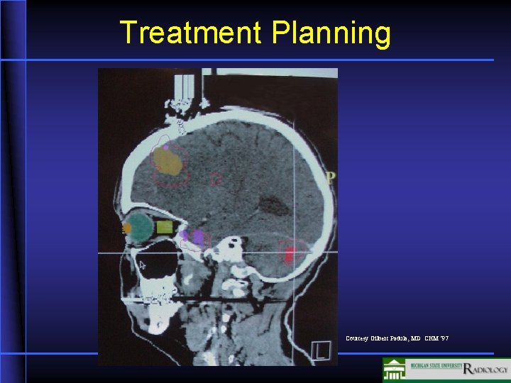 Radiation Therapy Radiation Therapy RT For Cancer About