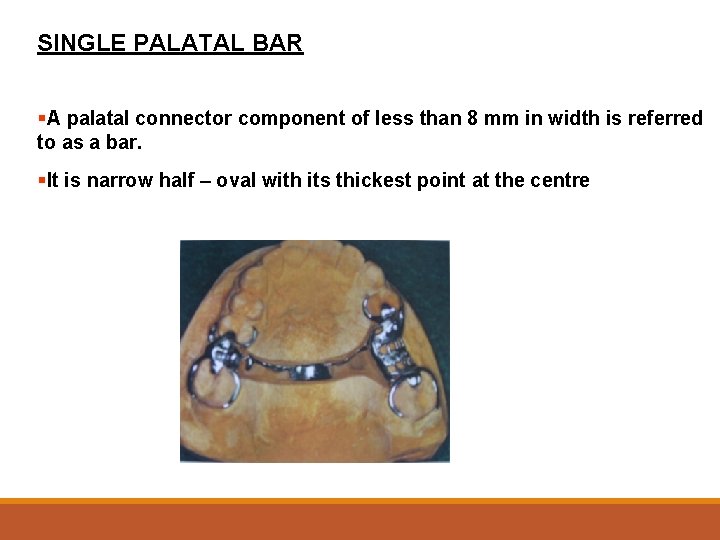 Major Connectors Components of a typical removable partial