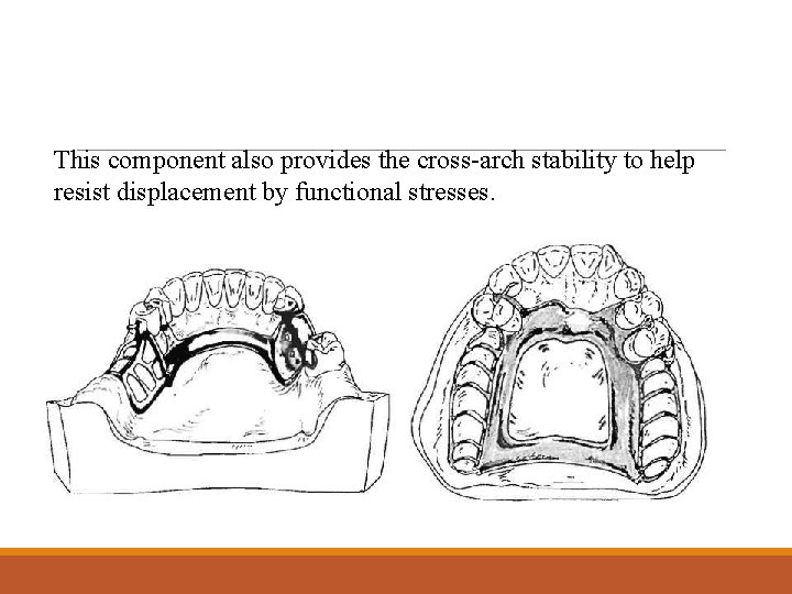 Major Connectors Components of a typical removable partial