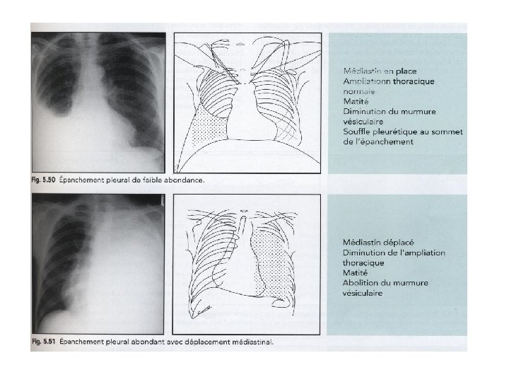 SEMIOLOGIE DE LAPPAREIL RESPIRATOIRE Dr k BENHARRATS medecine