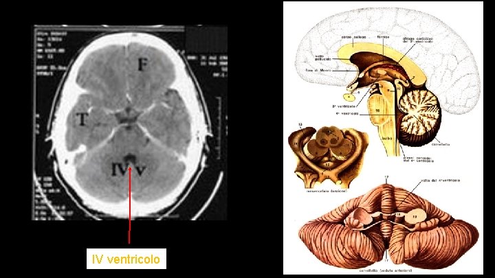 TECNICA E ANATOMIA TC ENCEFALO Dott Mattia Carbone