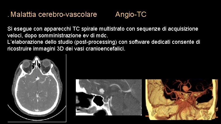 TECNICA E ANATOMIA TC ENCEFALO Dott Mattia Carbone
