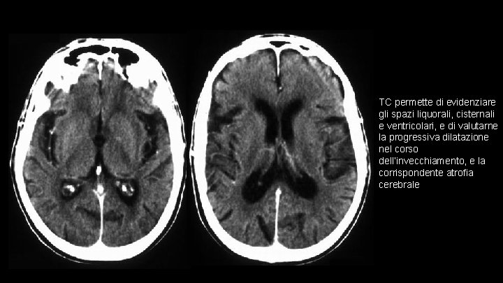 TECNICA E ANATOMIA TC ENCEFALO Dott Mattia Carbone