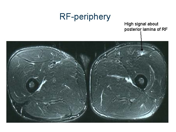 Acute Quadriceps Muscle Strains MRI features and prognosis