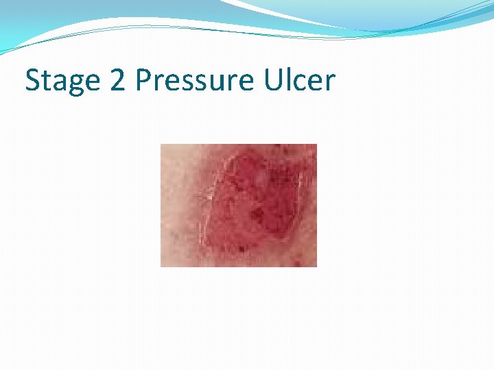 Drains Ostomies and Wound Products By Mark Vance