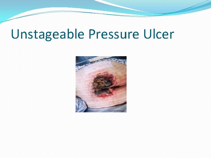 Drains Ostomies and Wound Products By Mark Vance