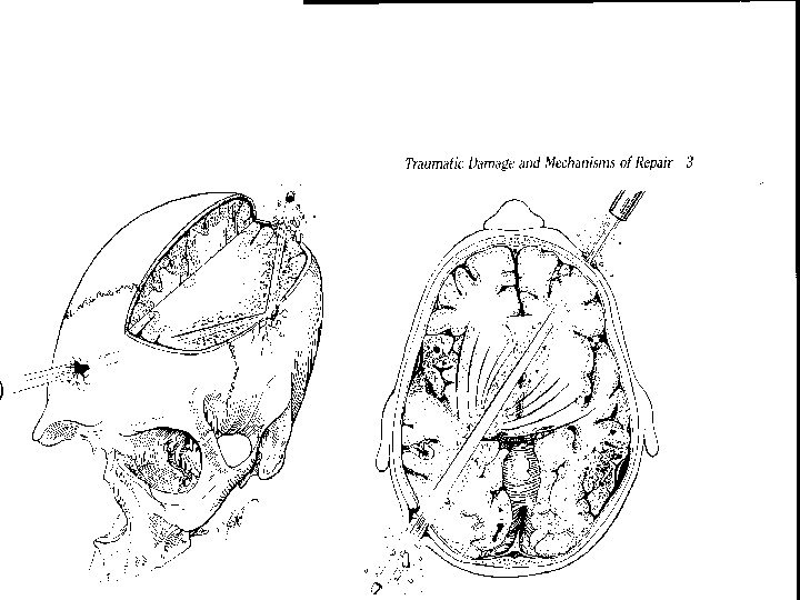 Traumatic Brain Injury Presented by David L Strauss